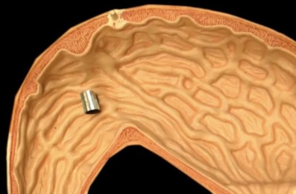 Groundbreaking Development: Scientists Unveil Soft Robot for Medical ...